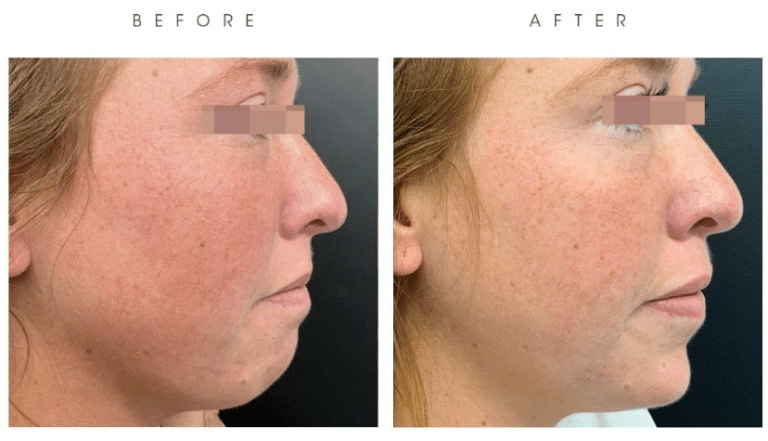 ODM/OEM 3D HIFU Machine - VIVA Concept Technology