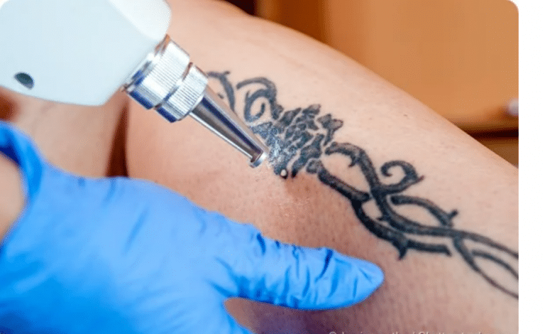Laser Tattoo Removal Machine - VIVA Concept Technology