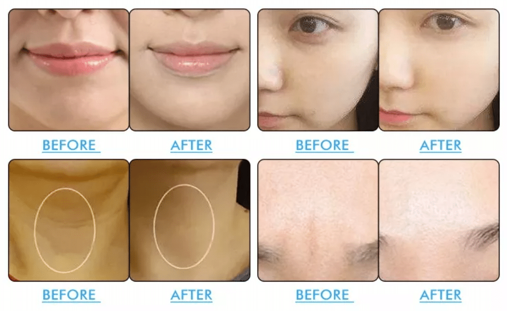 Wrinkle Removal Machine - VIVA Concept Technology