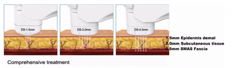 ODM/OEM hifu facial machine - VIVA Concept Technology