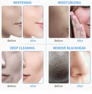 ODM/OEM Aqua Facial Machine - VIVA Concept Technology