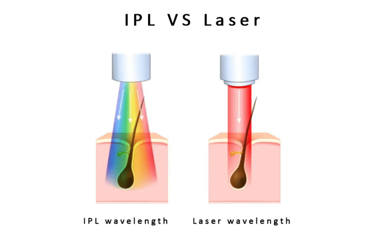 IPL VS Laser: A Comparison Of Two Popular Cosmetic Procedures - VIVA ...