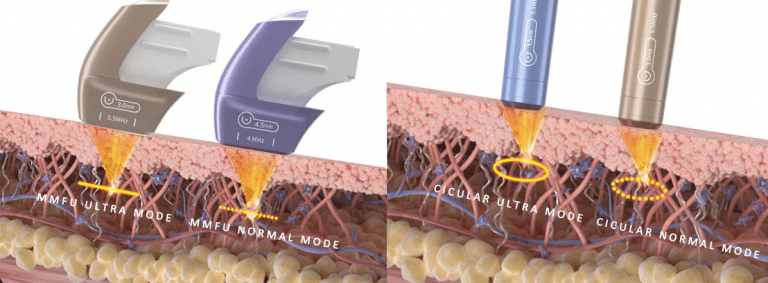 Ultraformer MPT Machine - VIVA Concept Technology