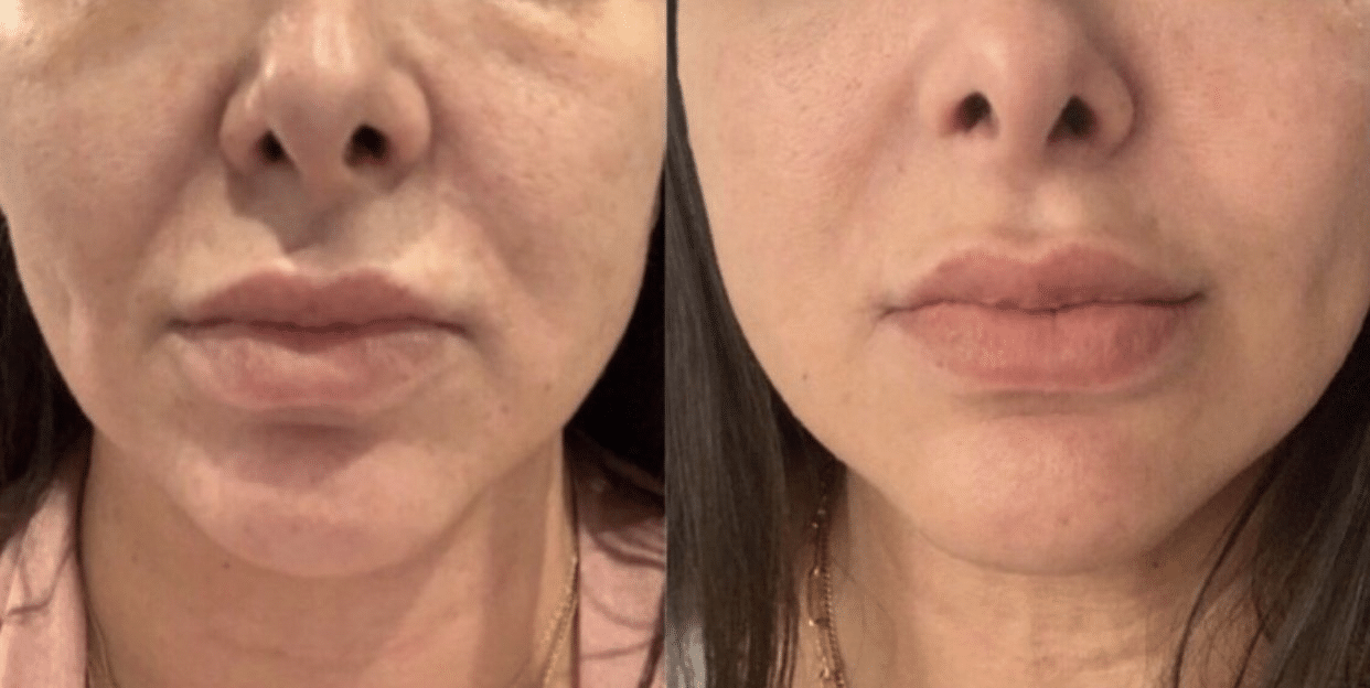 ODM/OEM HIFU Machine | Device Type & Price - VIVA Concept Technology