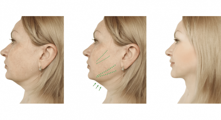 HIFU Machine For Double Chin - VIVA Concept Technology