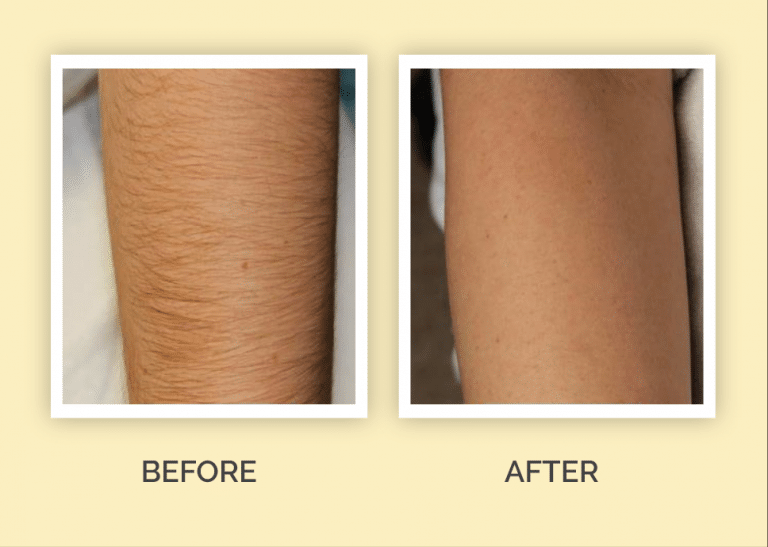 Body Laser Hair Removal - VIVA Concept Technology