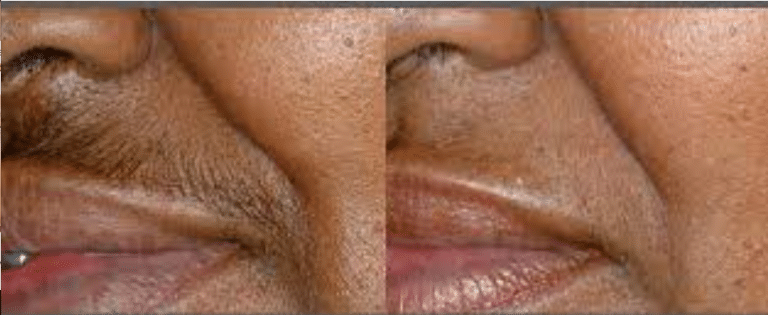 Laser Nose Hair Removal - VIVA Concept Technology