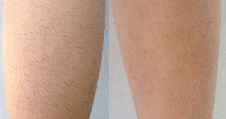 Legs Laser Hair Removal - VIVA Concept Technology