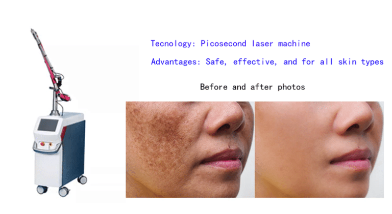 Best Laser Pigmentation Removal Machines - VIVA Concept Technology